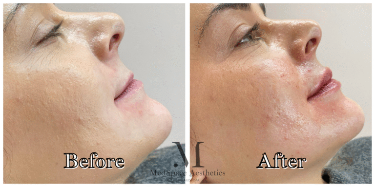 Perioral Rejuvenation - MedSpace Aesthetics